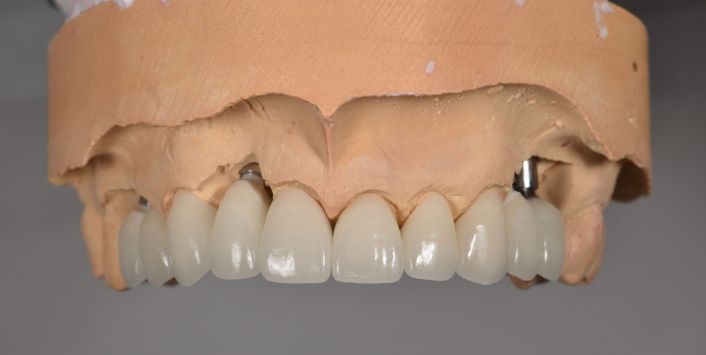 42-implant-restorations | Pindan Dental Laboratory